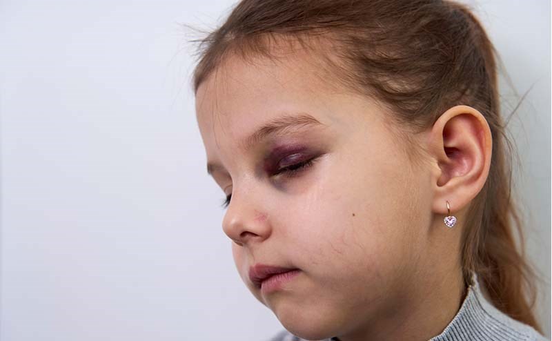 Eye Emergencies — Know When to Go to the ER