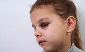 Eye Emergencies — Know When to Go to the ER